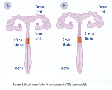 Inseminación artificial post cervical vs cervical